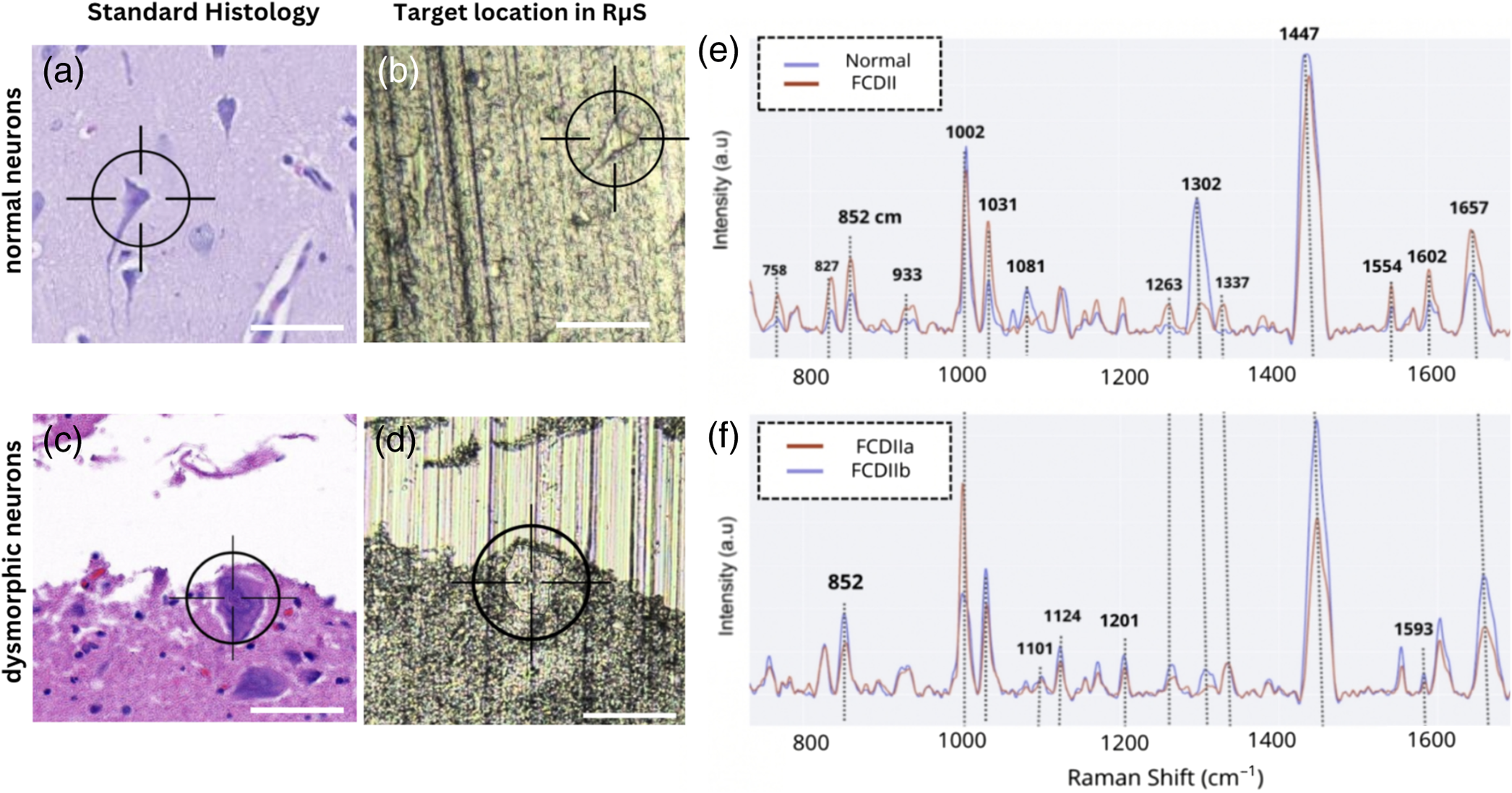 Single-cell Raman spectroscopy detects pediatric focal cortical dysplasia