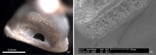 Femtosecond laser ablation of the stapes