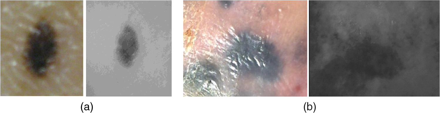 Classification of skin moles from optical spectropolarimetric images: a ...