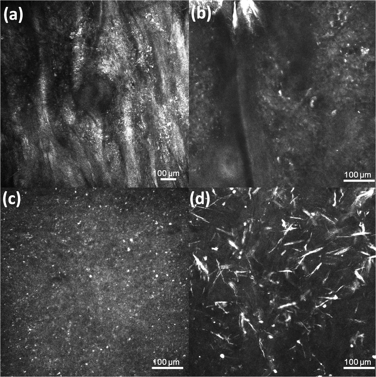 Optical diagnosis of a metabolic disease: cystinosis