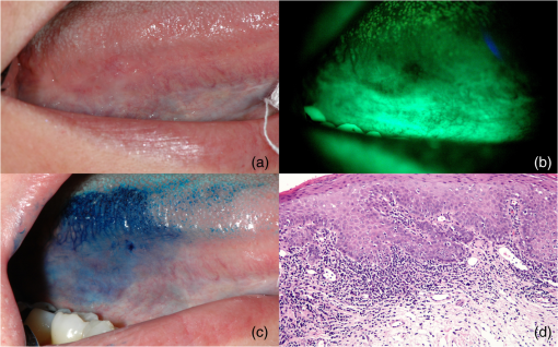 Toluidine Blue Staining For Oral Cancer - CancerWalls Toluidine Blue Staining For Oral Cancer - CancerWalls