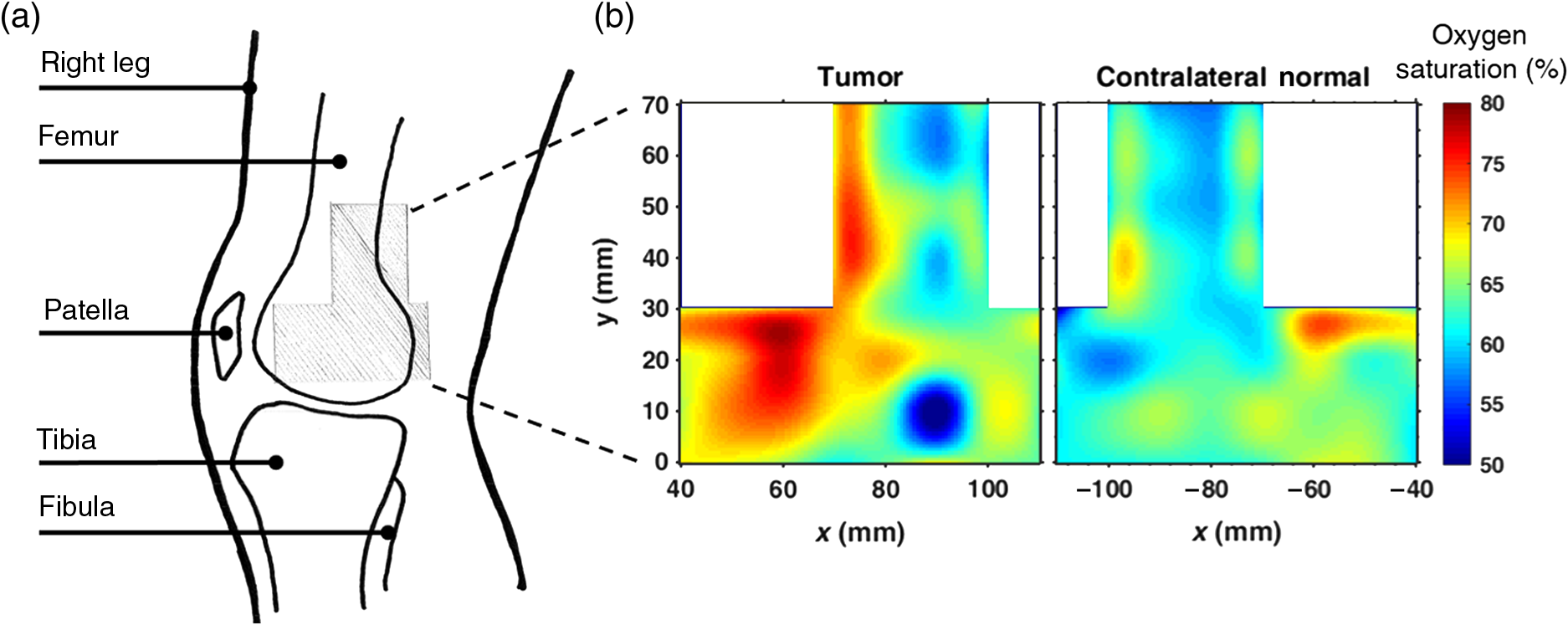 In vivo, noninvasive functional measurements of bone sarcoma using ...