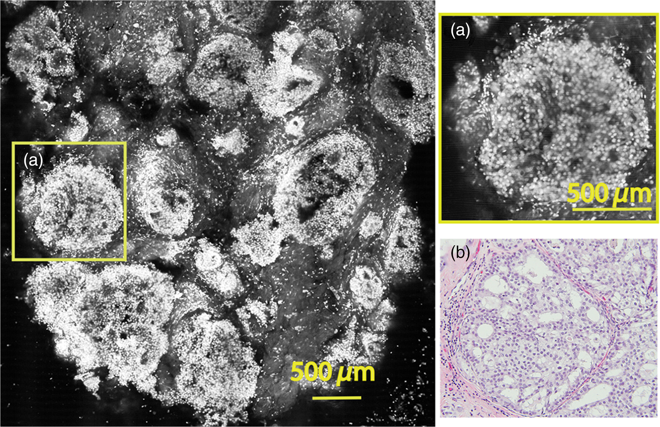 Evaluation of breast tissue with confocal strip-mosaicking microscopy ...