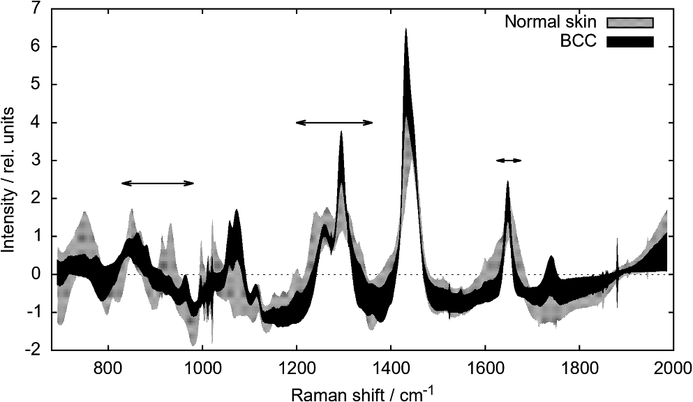 Nonscanning large-area Raman imaging for ex vivo/in vivo skin cancer ...