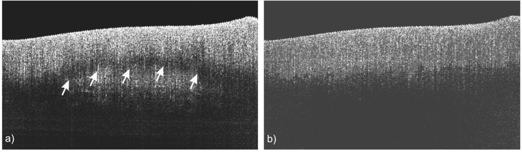 Hand-held arthroscopic optical coherence tomography for in vivo high ...