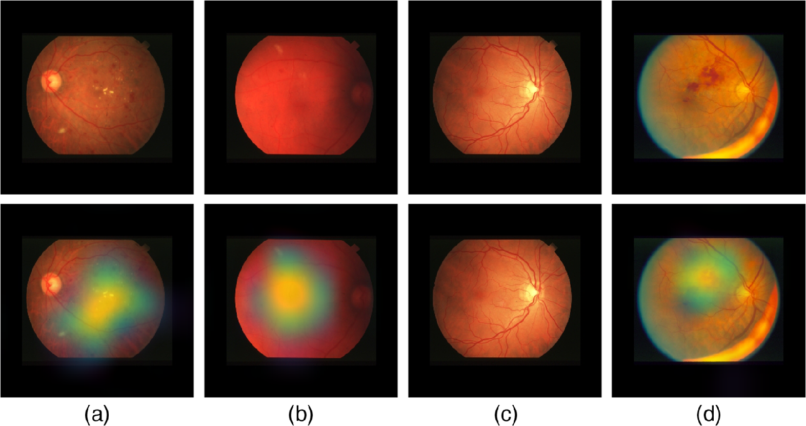 Explainable end-to-end deep learning for diabetic retinopathy detection ...