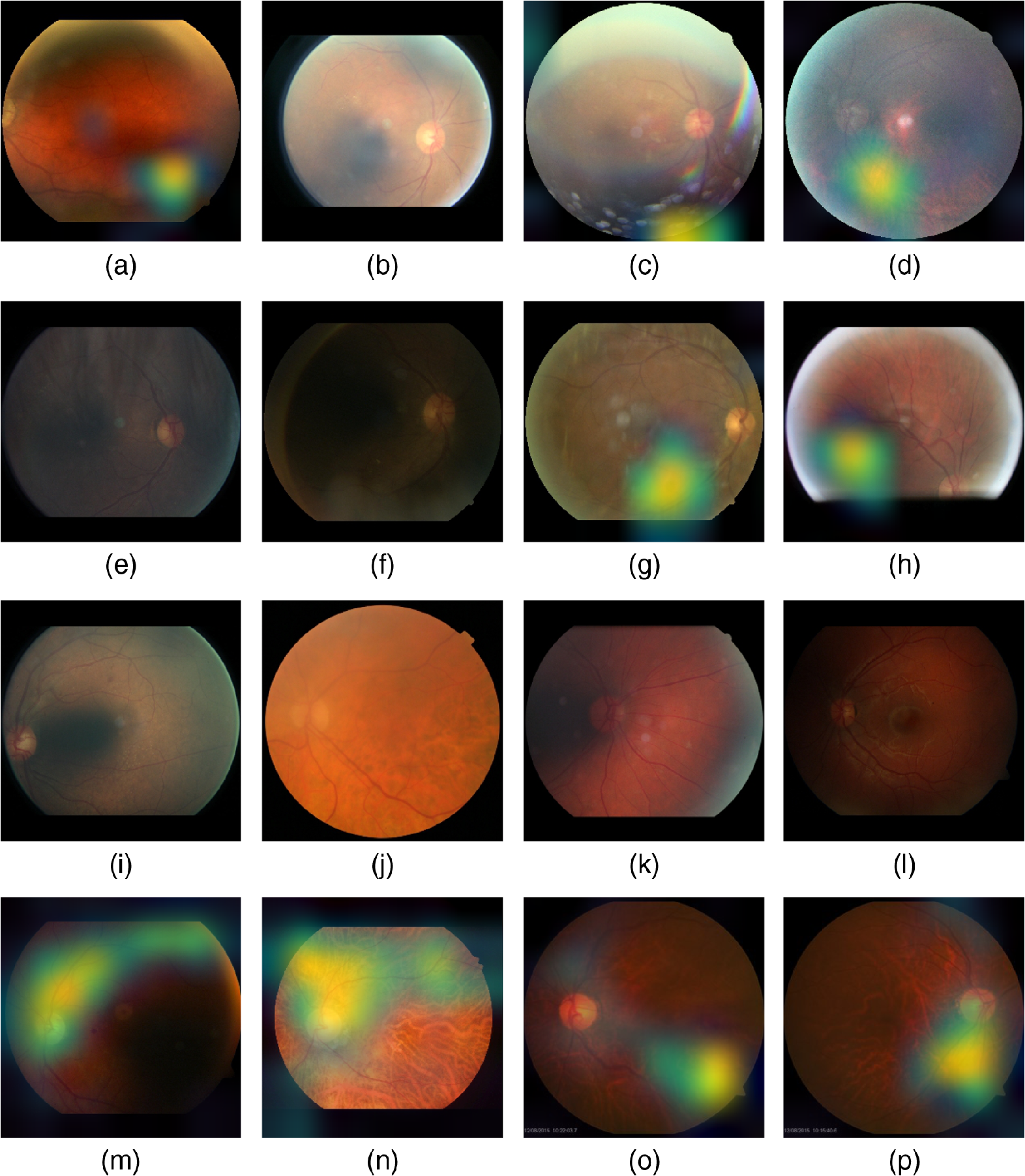 Explainable end-to-end deep learning for diabetic retinopathy detection ...