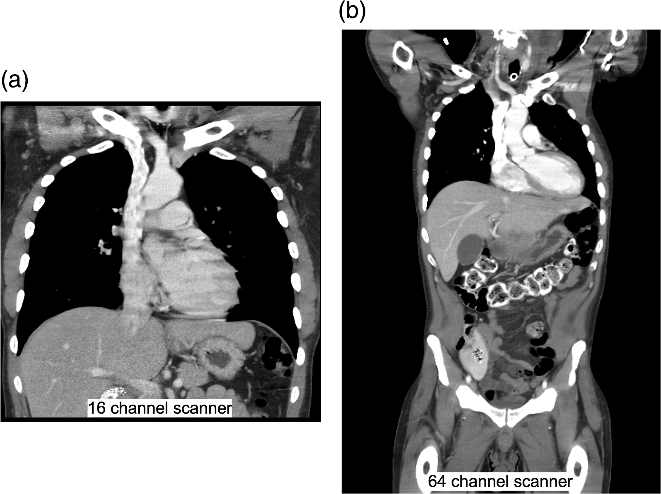 From EMI to AI: a brief history of commercial CT reconstruction algorithms