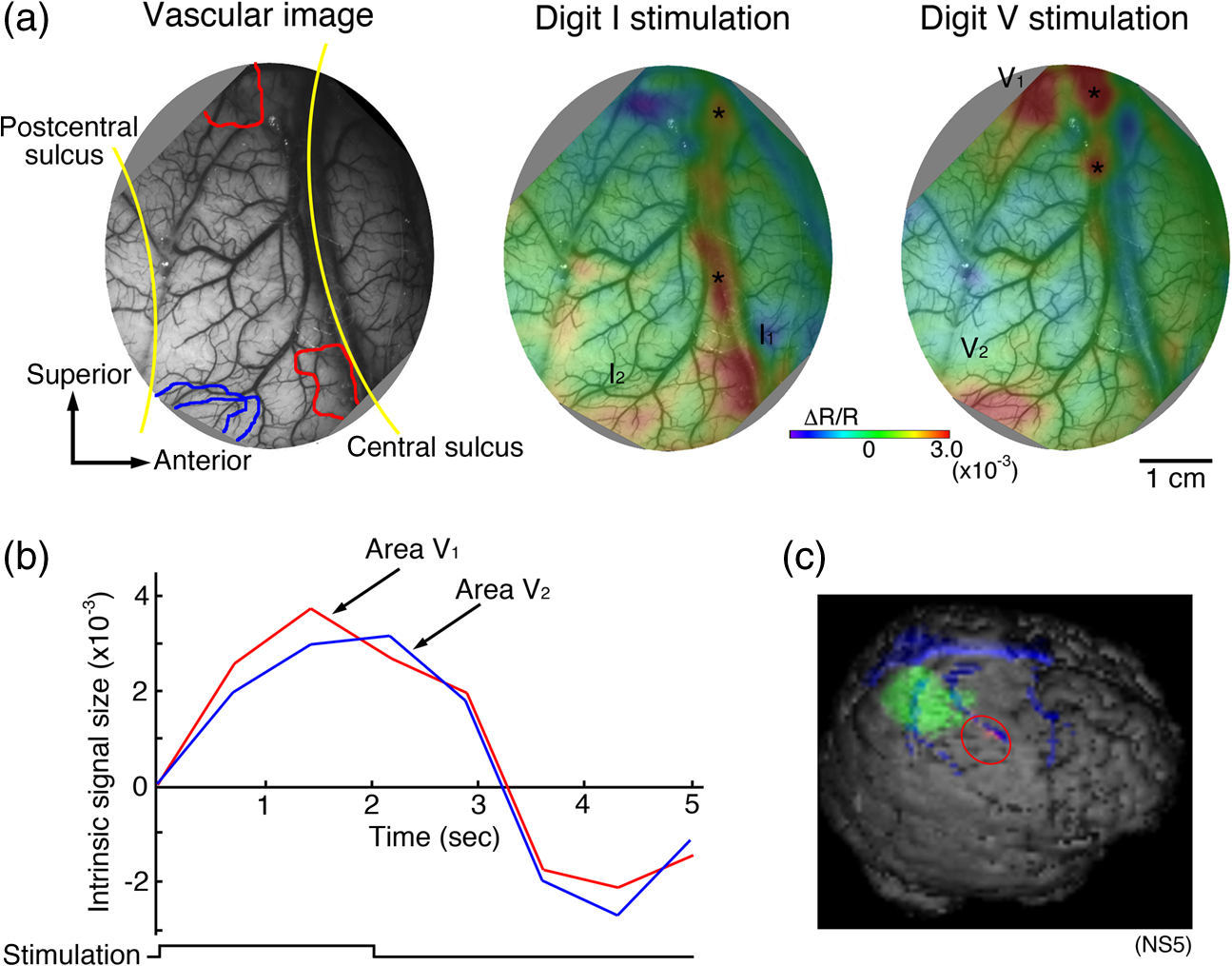 Intraoperative intrinsic optical imaging of human somatosensory cortex ...