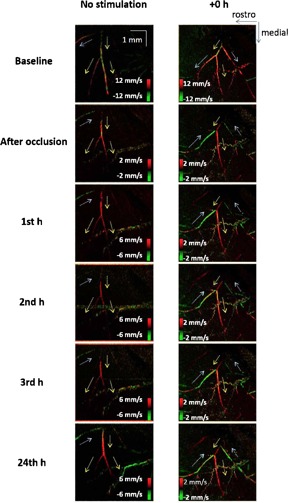 Spatiotemporal dynamics of pial collateral blood flow following ...