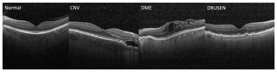 Diagnosis of retinal diseases using the vision transformer model based ...